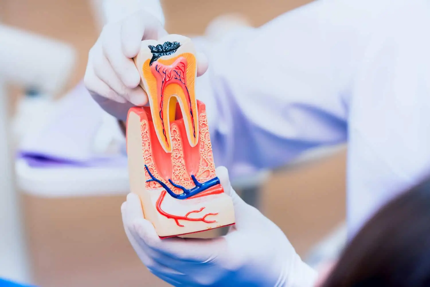 Can a tooth with root canal treatment be extracted? | Dent X International